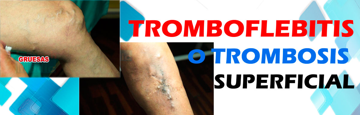 Tromboflebitis o Trombosis Superficial | GLOMACH MEDIC VARICES