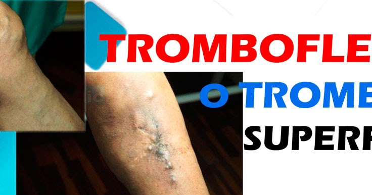 Tromboflebitis o Trombosis Superficial | GLOMACH MEDIC VARICES