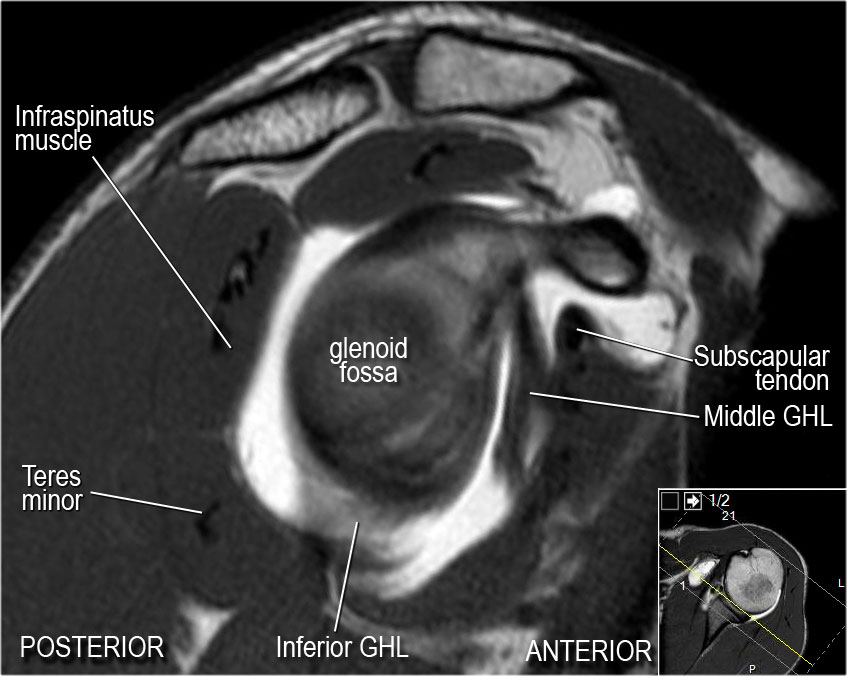 MRI Musculo-Skeletal Section: How to locate glenohumeral ligaments.