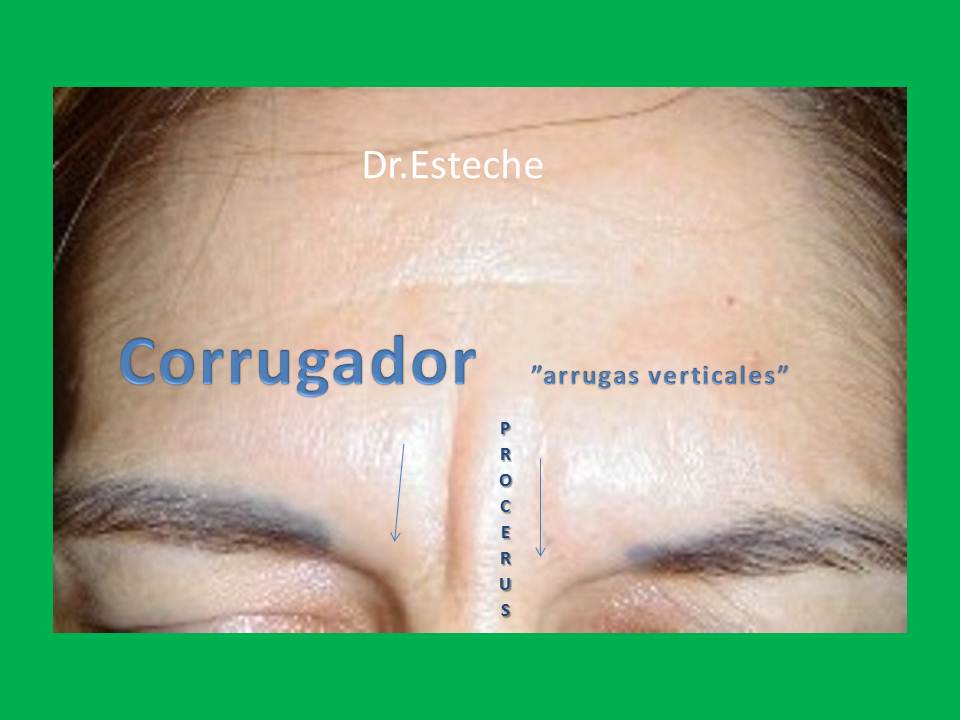 Dr.Esteche | Cirugía Plástica Facial | Cirugía Facial: CORONAL INCISION ...