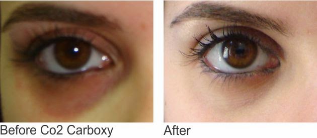 Medical Treatment Pictures-for Better Understanding: Retinal Laser ...