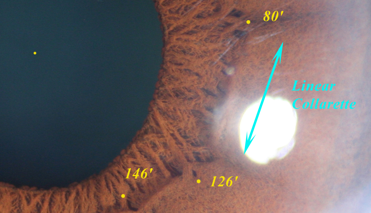 Modern & Multidimensional Iridology: Significant of Iris Signs - Rx - (tfy)