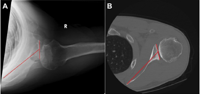 UW Shoulder and Elbow Academy: Addressing glenoid retroversion in total ...