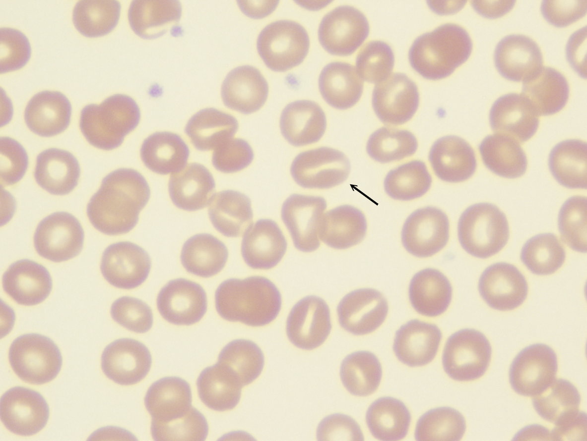 La sangre: Alteraciones en los eritrocitos