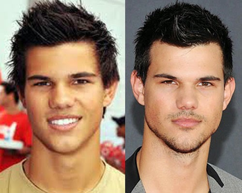 Taylor Lautner Nose Job
