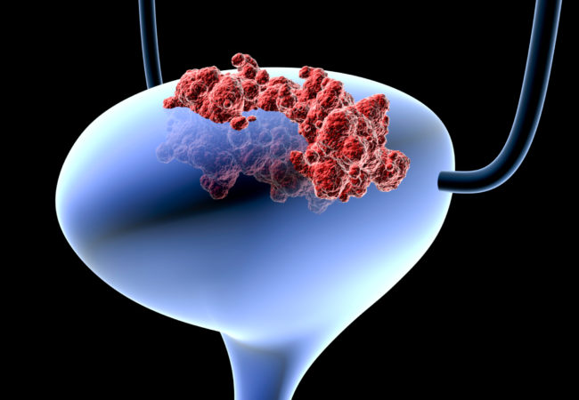 Bladder Cancer: Can it be Recognized Early?