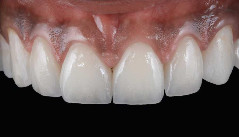 Procera® AllCeram (Nobel Biocare)