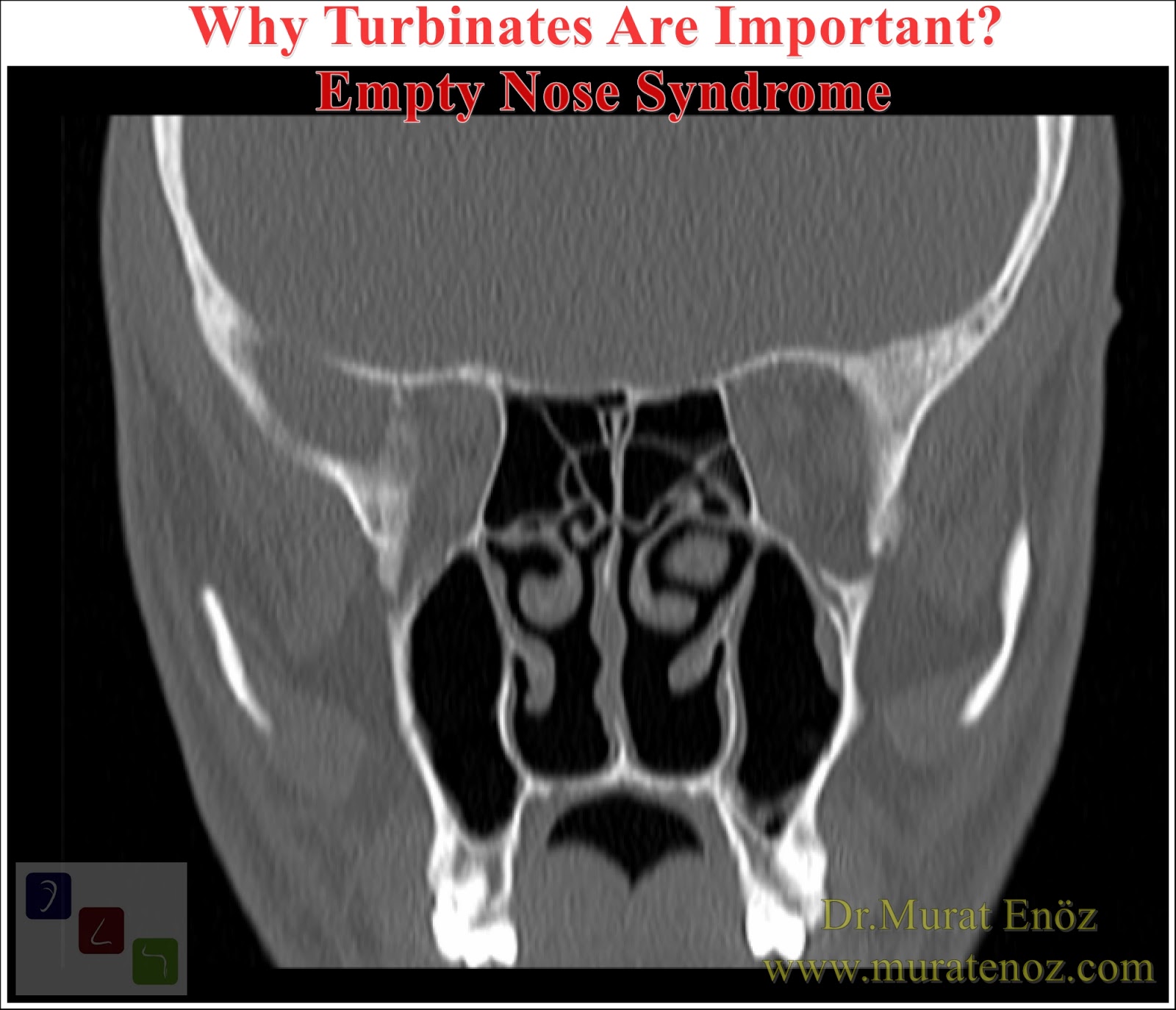 Why Turbinates Are Important? - Empty Nose Syndrome