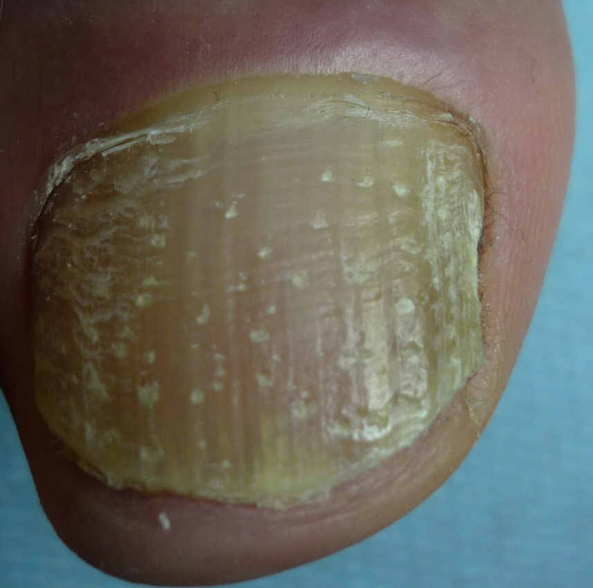 Plantillas Deportivas Blog: Psoriasis de las uñas