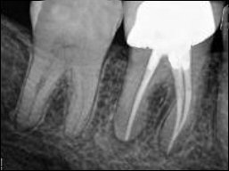 Root Canal Treatment