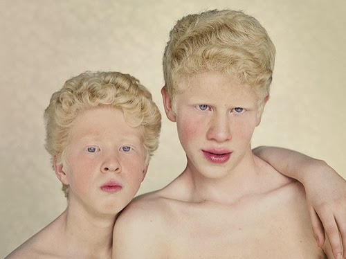 Genetic Disorder Public Campaign- Albinism: DIAGNOSIS