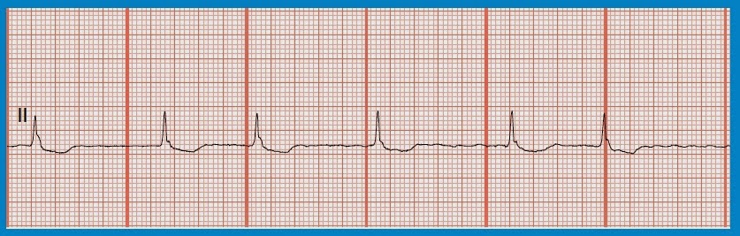 Various Atrial Fibrillations