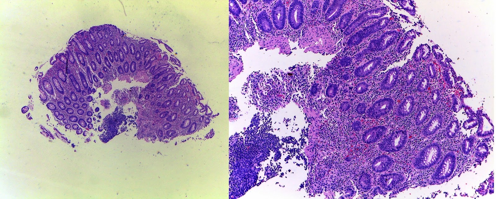 GASTROINTESTINAL AND LIVER HISTOLOGY PATHOLOGY ATLAS: COLON: INFECTIOUS ...