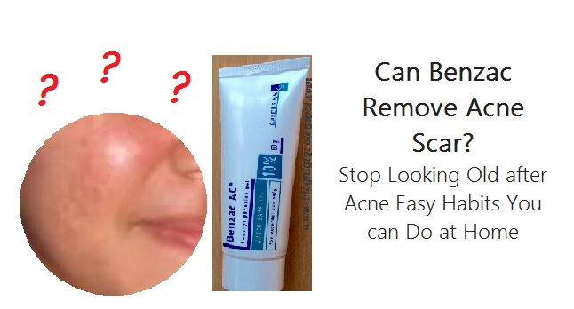 Blognigigi: Invest in Yourself: Can Benzac Remove Acne Scar? || Stop ...