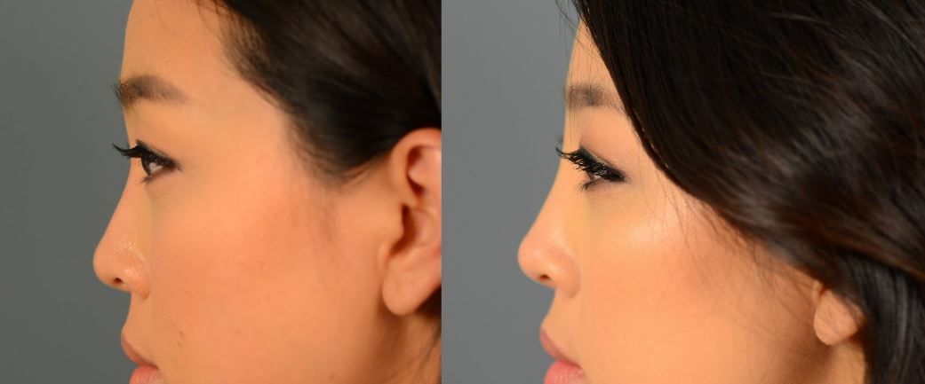 Plenitude: Nonsurgical rhinoplasty of the Asian nose