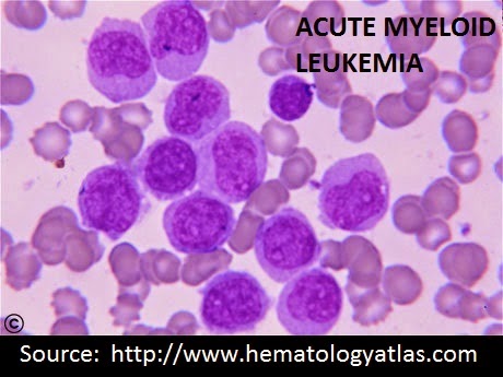Lab Atlas: Acute Myeloid Leukemia