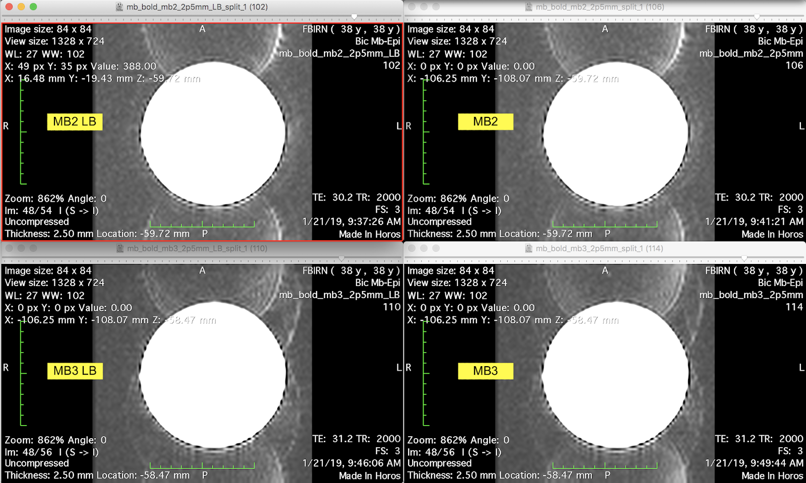 practiCal fMRI: the nuts & bolts: Using multi-band (aka SMS) EPI on on low-dimensional array coils