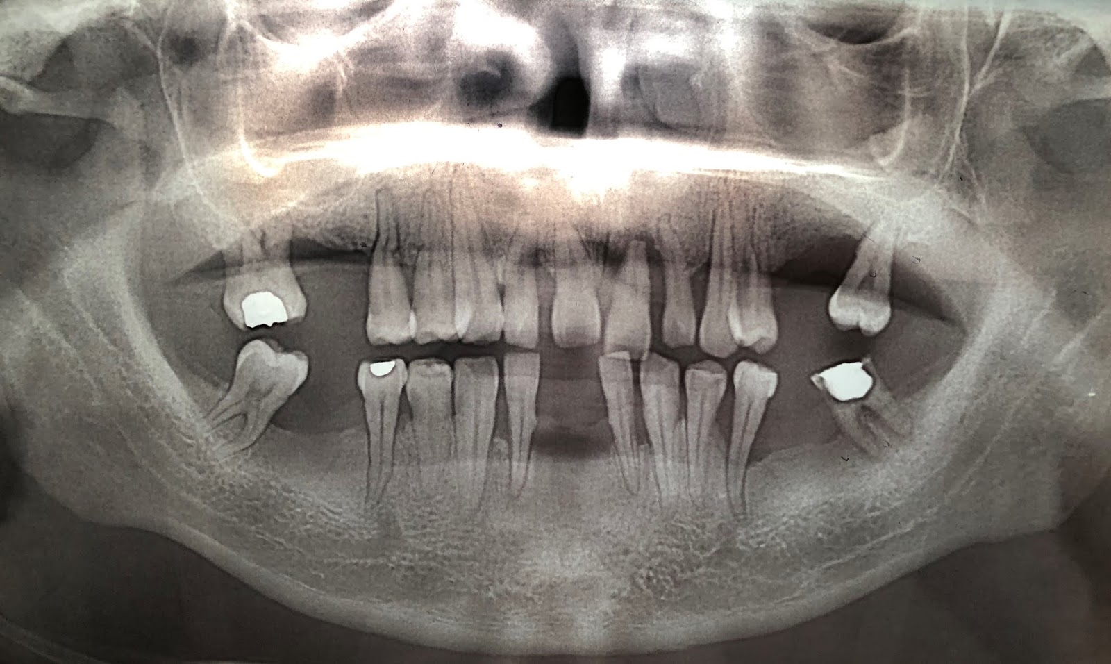 PERIODONCIA: CASO CLÍNICO