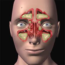 Health All: Symptoms and Causes of Sinusitis Infection