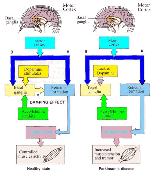 Classification Parkinson's disease |Genetic Engineering Info