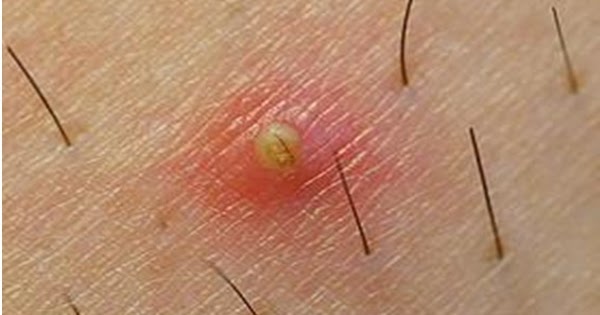 TrimmingHelp: Ingrown hair removing tools