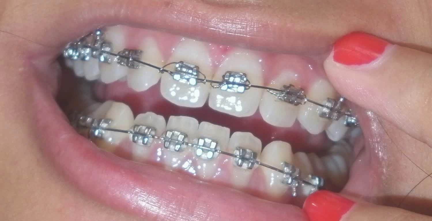 Awas Bahaya Penggunaan Behel Abal-abal !!! - KESEHATAN GIGI DAN MULUT