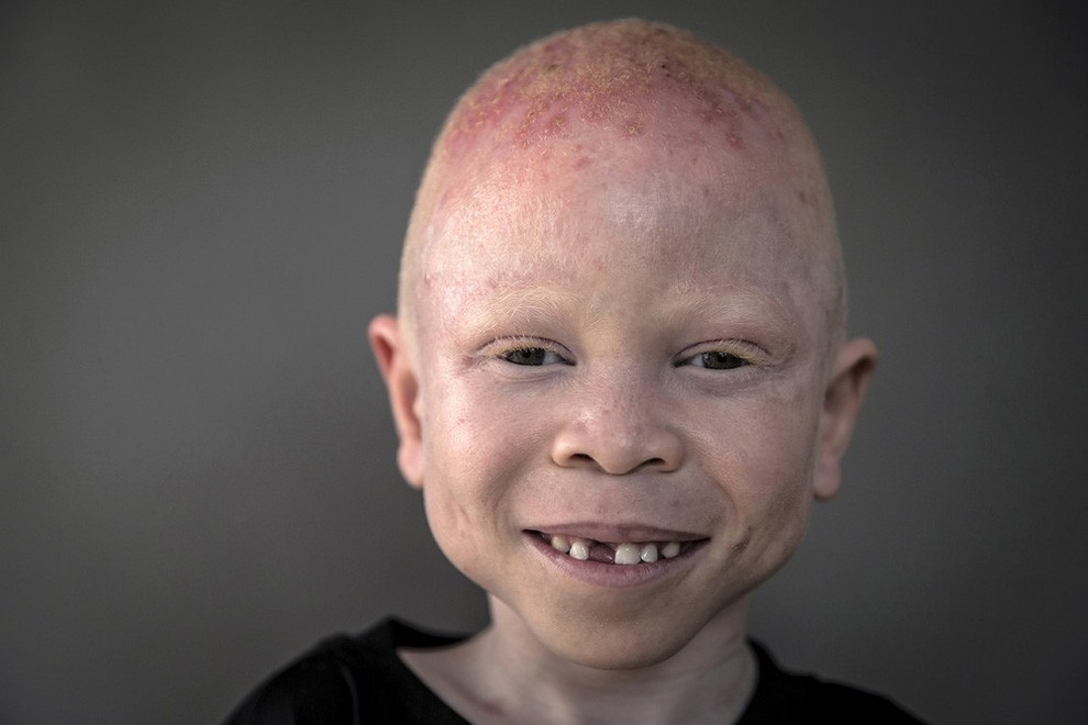 Occhi fragile: Niños albinos de Tanzania
