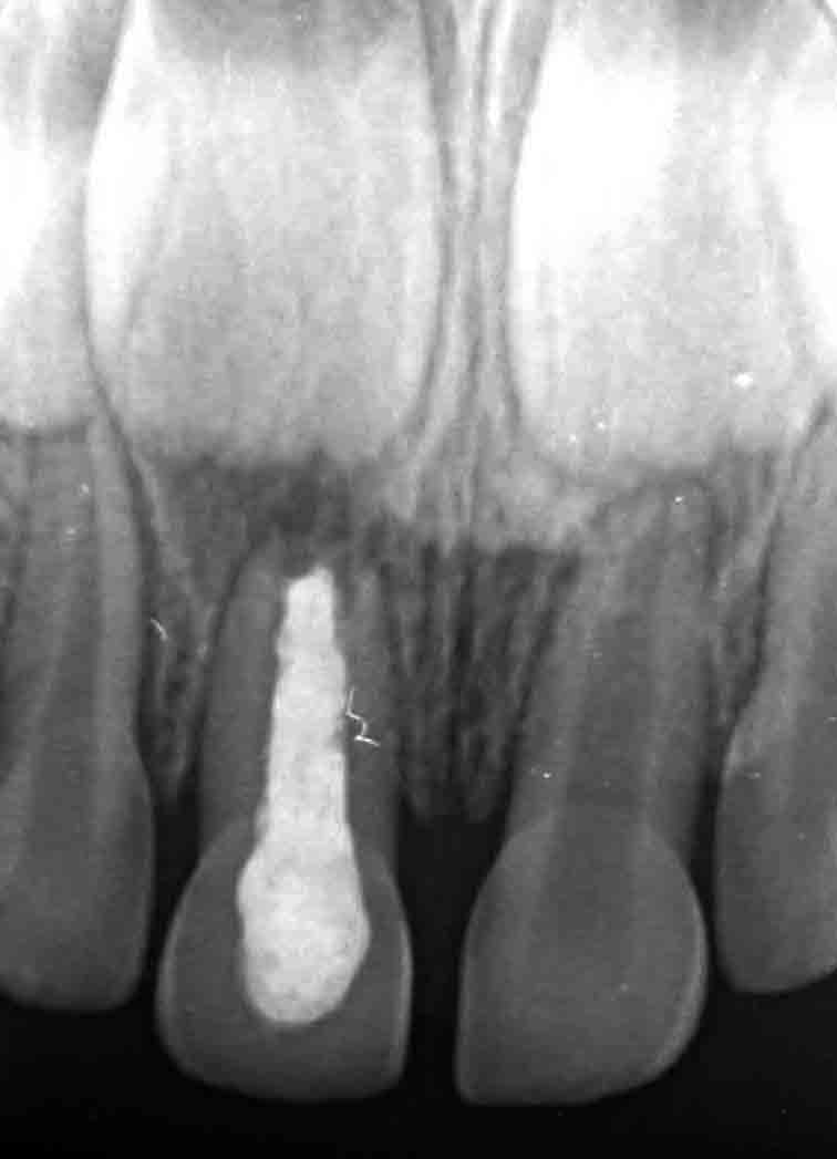 Una Boca para toda la Vida: Traumatismos dentales en niños