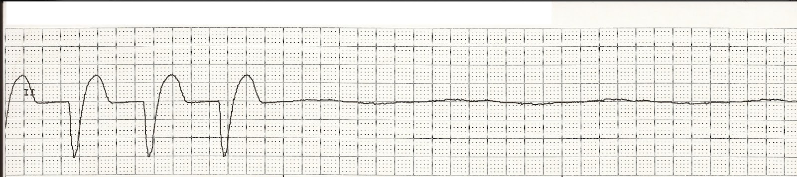 ACLS Rhythms: Ventricular rhythms