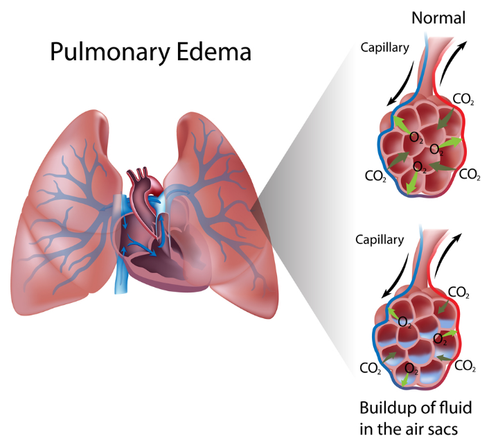 Mayom Hospitals : Pulmonary Edema