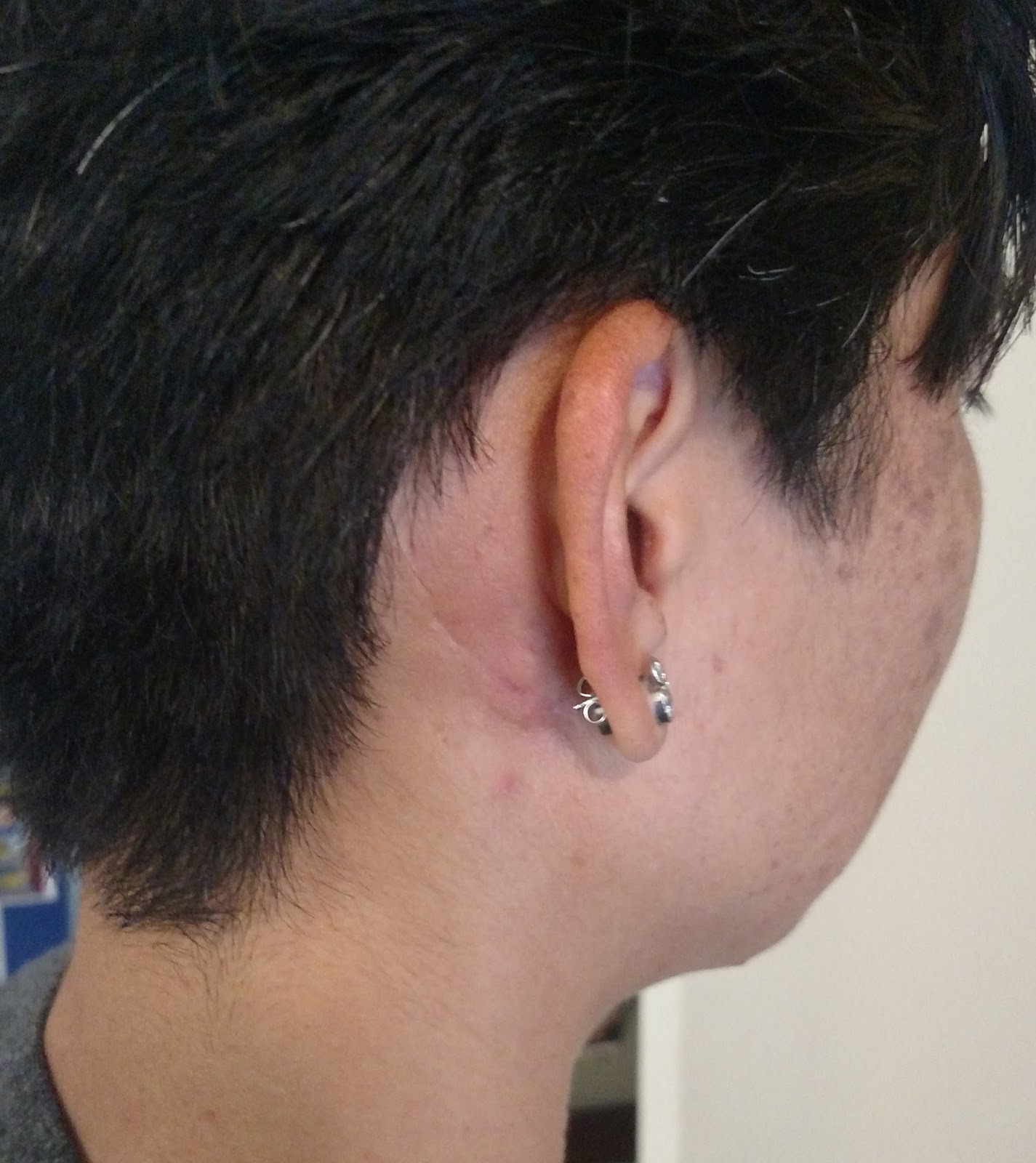 Arnold the Acoustic Neuroma: April 2017