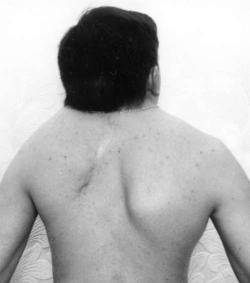 Klippel-Feil Syndrome Pictures | Medical Pictures and Images - (2023 ...