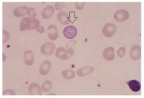 FICHERO HEMATOLOGIA : Anillos de Cabot