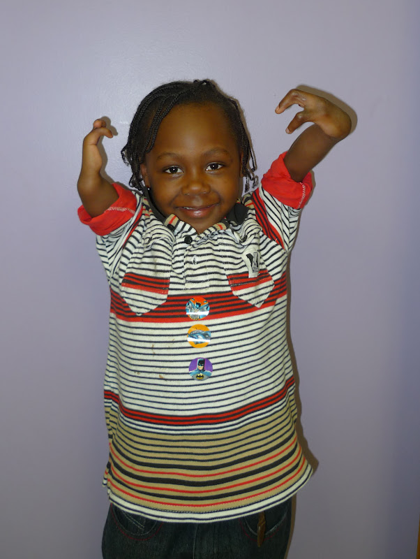 Great Function in Ulnar Deficiency | Congenital Hand and Arm ...