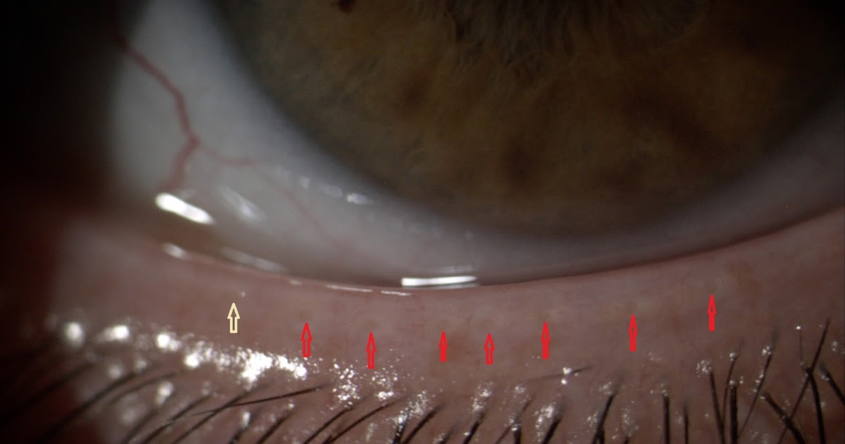 GLANDULAS DE MEIBOMIO