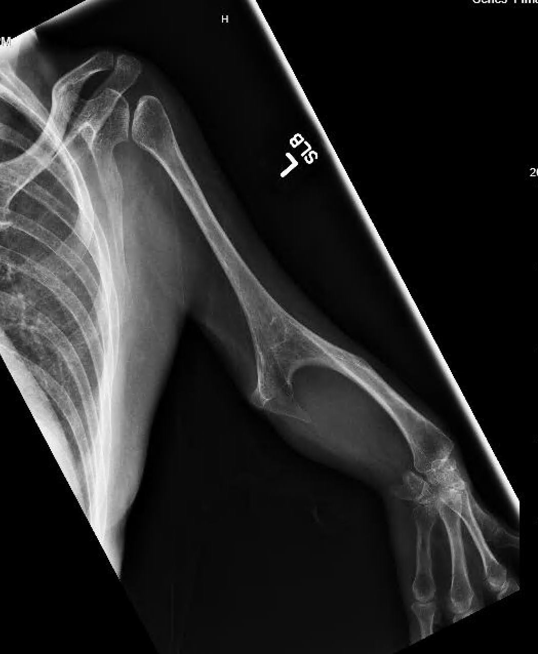 Short arm and hand deficiency- phocomelia or longitudinal deficiency ...