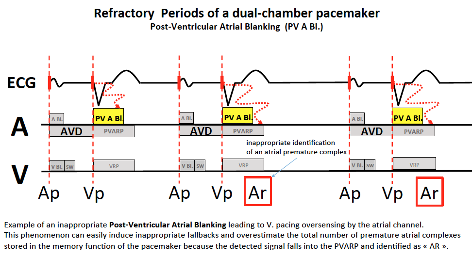 Dr Han Naung @ Henry Han : Electrophysiology and Heart Rhythm : AV ...