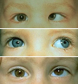 De cima para baixo: estrabismo convergente, divergente e vertical