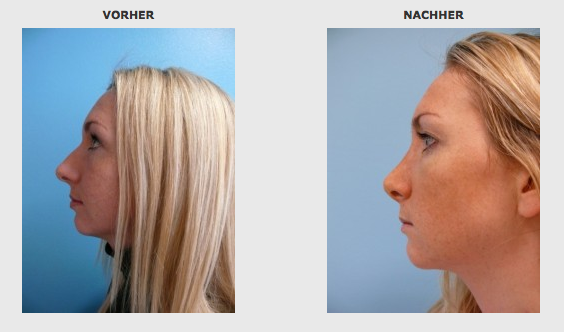 Rhinoplasty Journey: Prof. Dr. Werner Mang, Germany