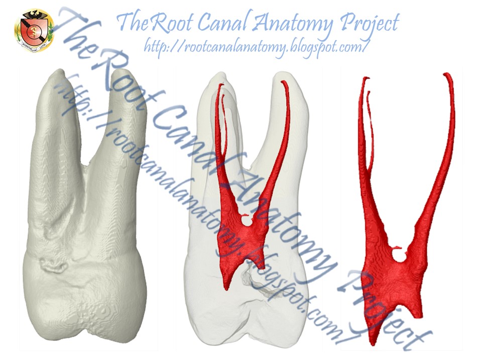 The Root Canal Anatomy Project: Three-Rooted Maxillary Premolar