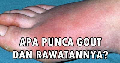 APA PUNCA GOUT DAN RAWATANNYA?