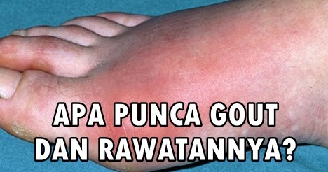 APA PUNCA GOUT DAN RAWATANNYA?