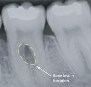 Omni Dental Group: Furcation Involvement
