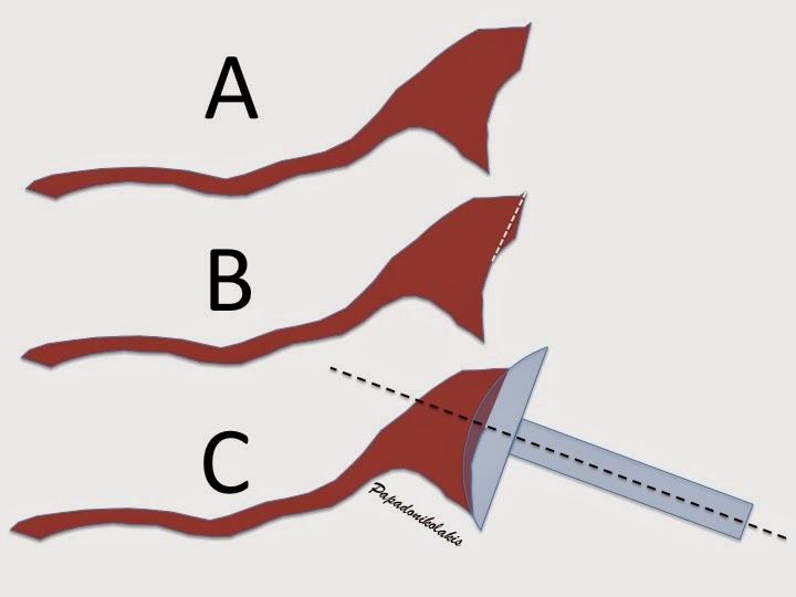 Shoulder and Elbow Surgery: How to ream a biconcave glenoid and when to ...