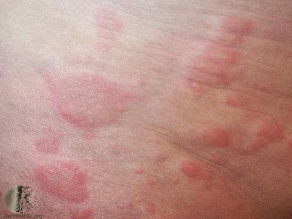 Indo news updates: Kenali Bintik-bintik pada Demam Berdarah, Campak ...