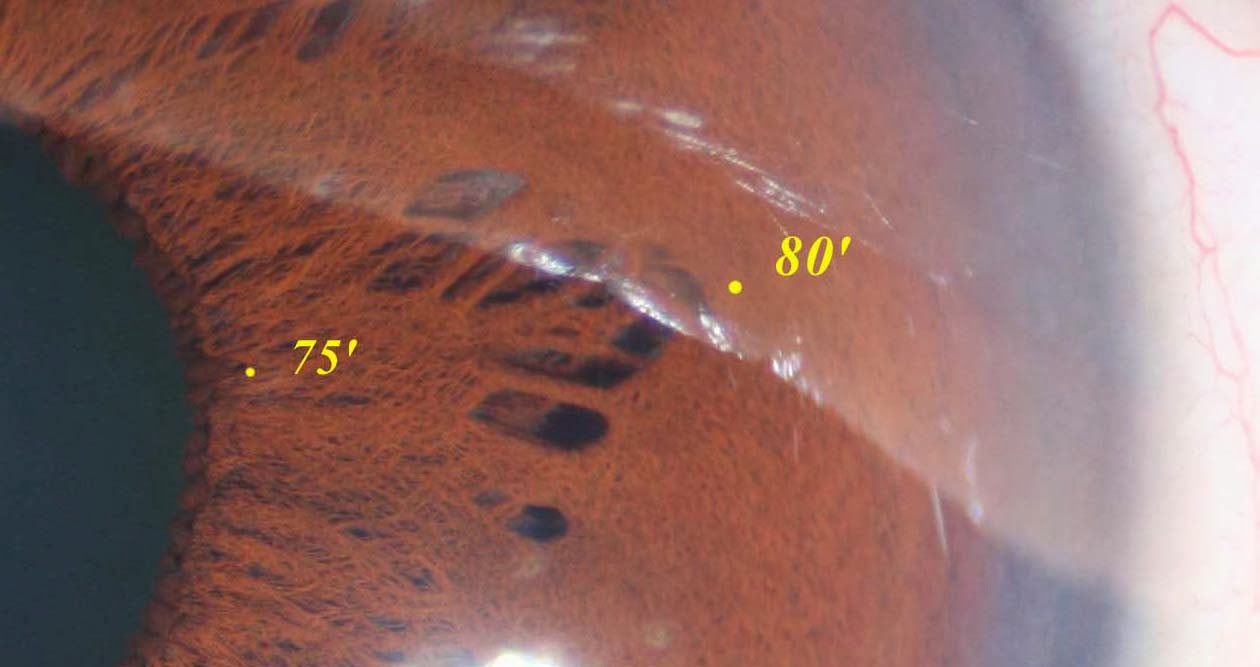 Modern & Multidimensional Iridology: Inner Pupillary Border - Standard ...