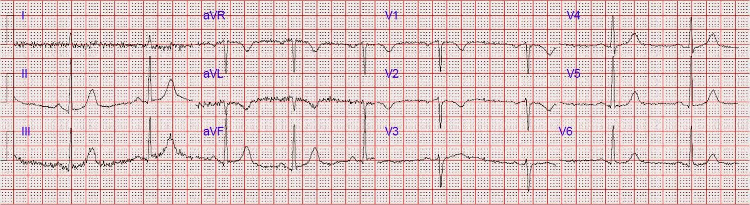 Dr. Smith's ECG Blog: The development of an inferior-posterior STEMI ...