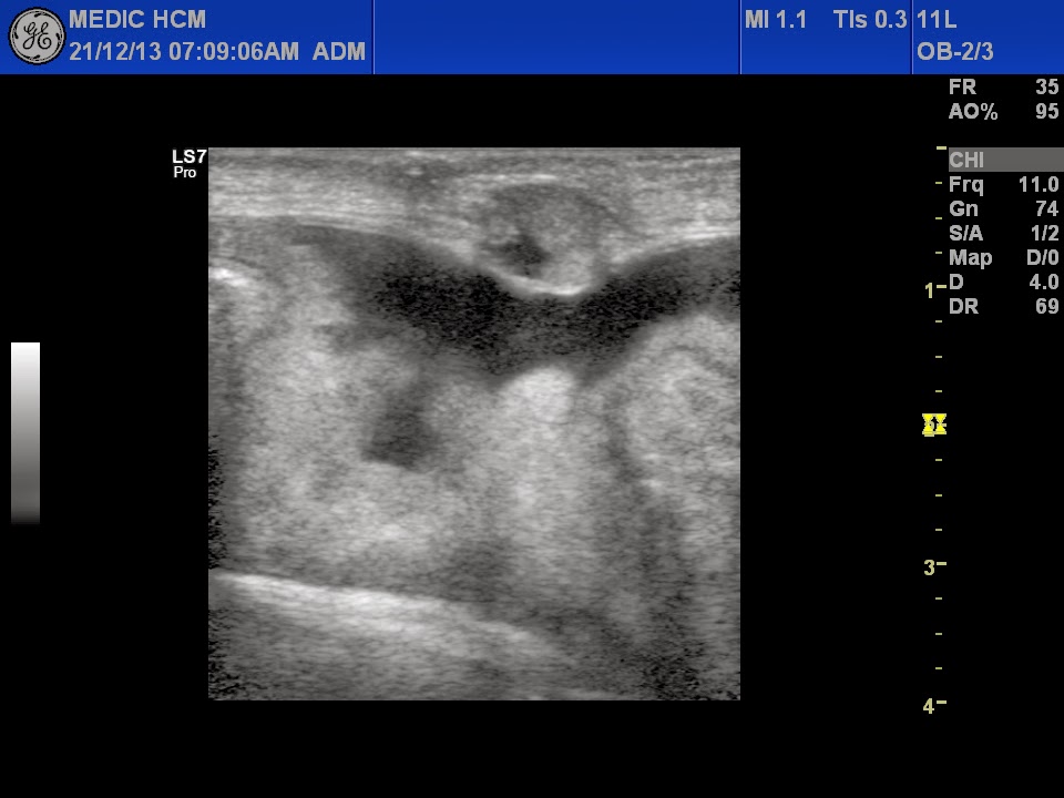 VIETNAMESE MEDIC ULTRASOUND: CASE 227: Umbilical Tumor, Sister Mary ...