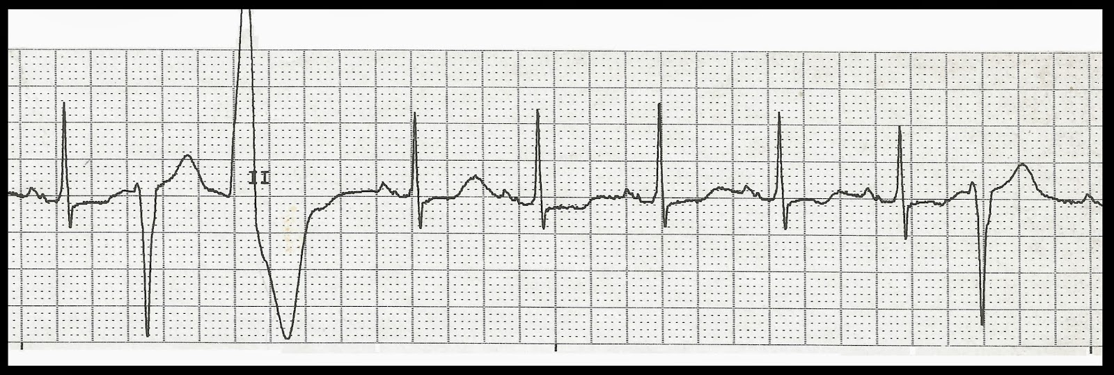 Practice EKG Rhythm Strips 227