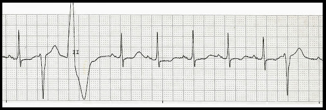 Practice EKG Rhythm Strips 227